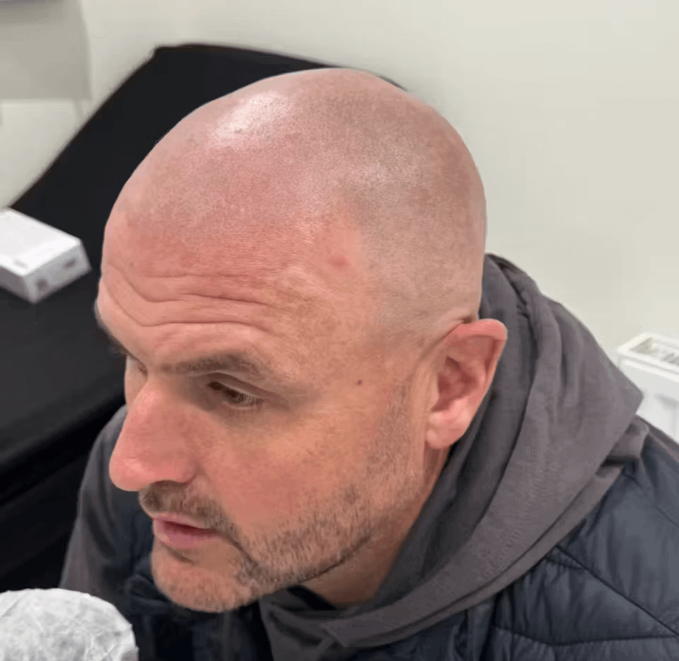 Scalp Micropigmentation in Bristol | EJ Hair Clinic