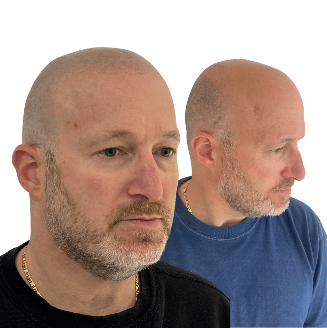 Scalp Micropigmentation in Bristol | EJ Hair Clinic